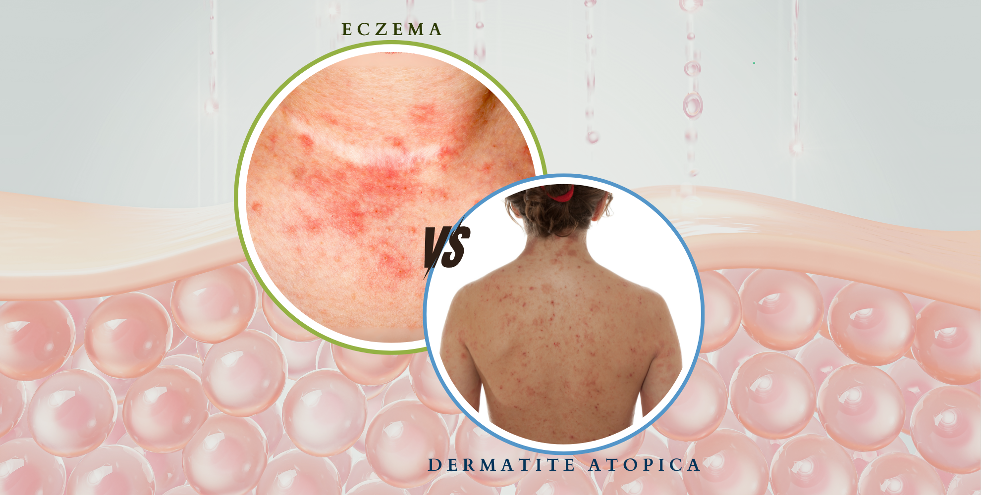 Eczema e Dermatite Atopica: 5 Consigli per Gestirli nella Vita ...